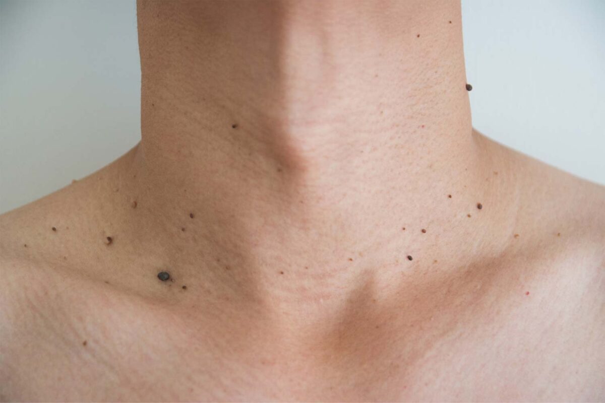 Specialized Skin Tag Removal Temecula | Remove Skin Tags